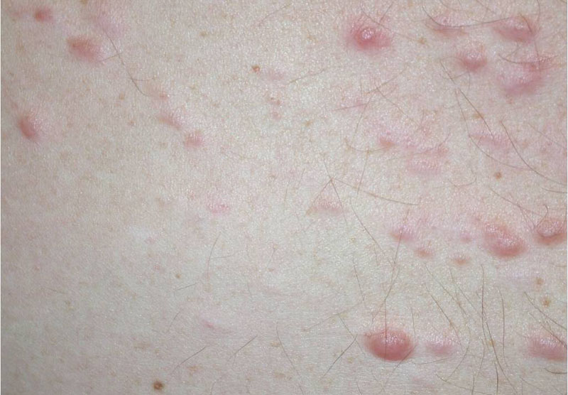 Leiomyoma The Clinical Advisor
