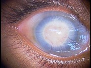 Corneal Opacity The Clinical Advisor Corneal Opacity The Clinical Advisor