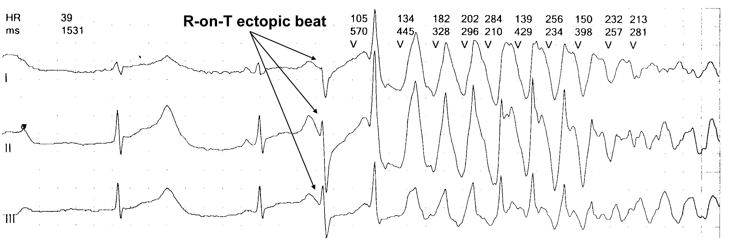 Long QT Syndromes and Torsade de Pointes - The Clinical Advisor Long QT Syndromes and Torsade de Pointes - The Clinical Advisor