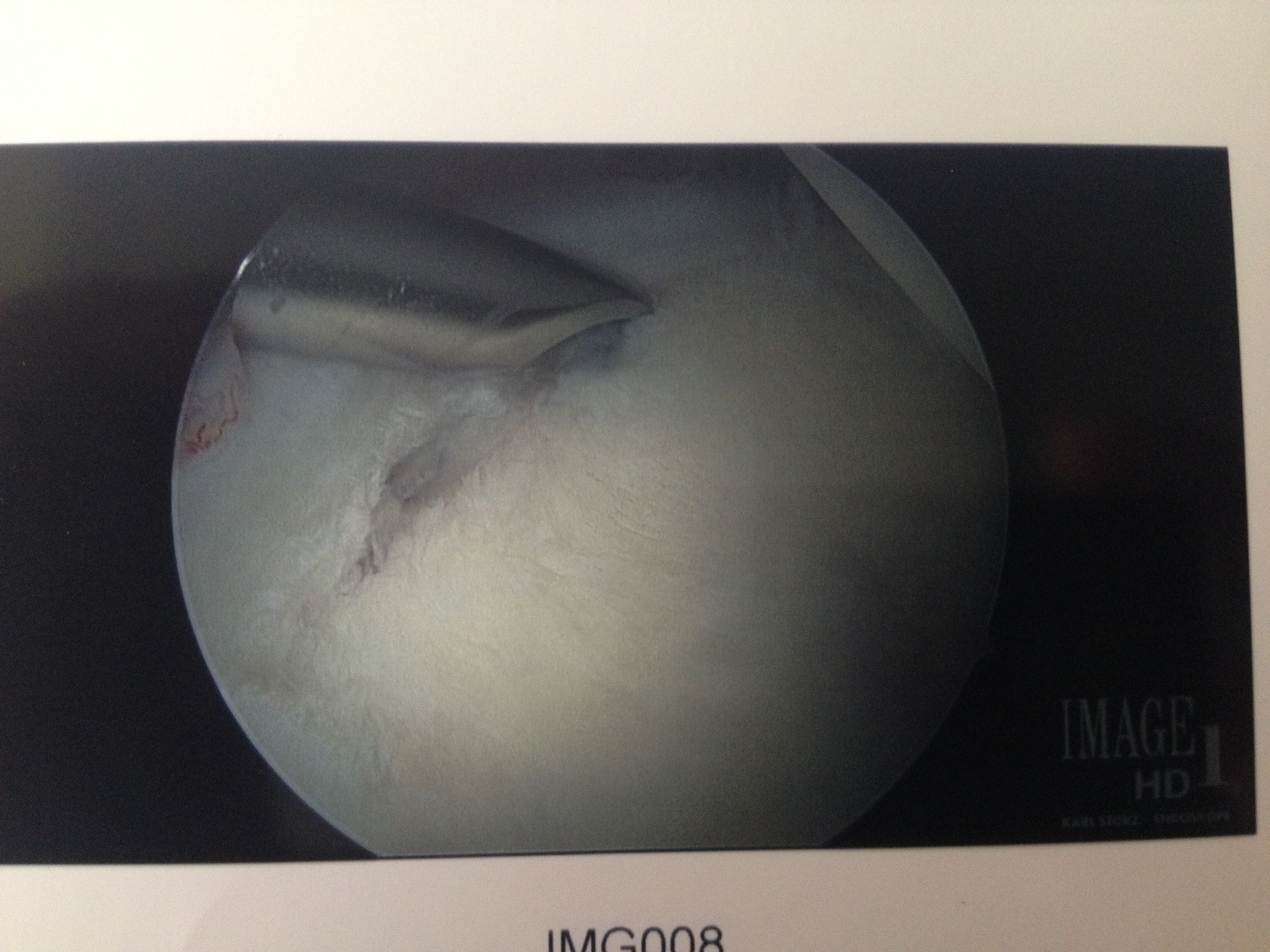 Treatment Of Posterior Labral Tears The Clinical Advisor