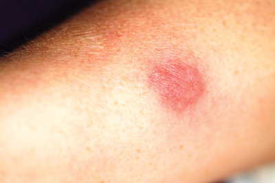 Red lesions on the extremities - The Clinical Advisor