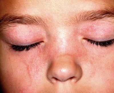 Pediatric facial rashes - The Clinical Advisor