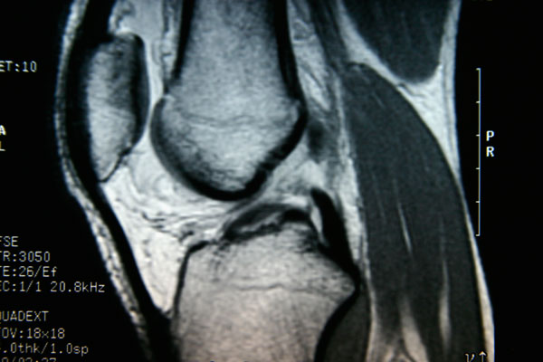 Anterior cruciate ligament rupture