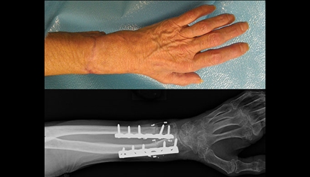 Accidental hand ­amputation requires ­extensive surgery - The Clinical ...