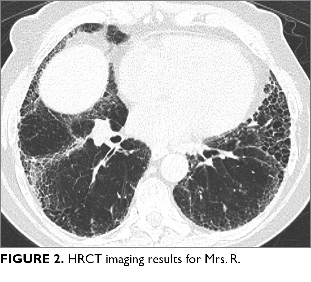 Using an evidence-based approach to diagnose IPF - Clinical Advisor
