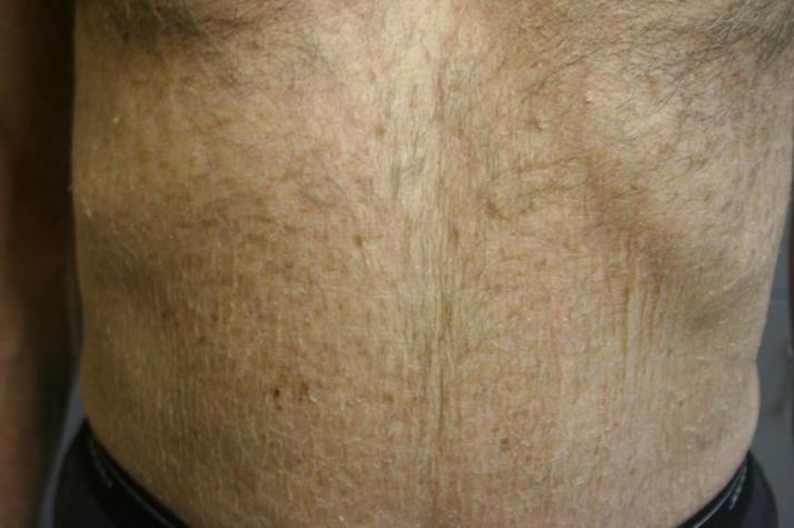 X Linked Ichthyosis Disorders Mostly Limited To The Epidermis And