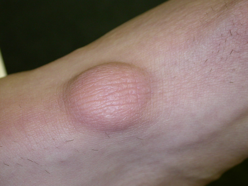 Knuckle Pads (Heloderma, Athlete's Nodules, Surfer's Nodules, Running ...