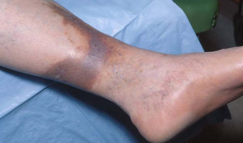 Lipodermatosclerosis (hypodermitis sclerodermiformis, sclerosing ...