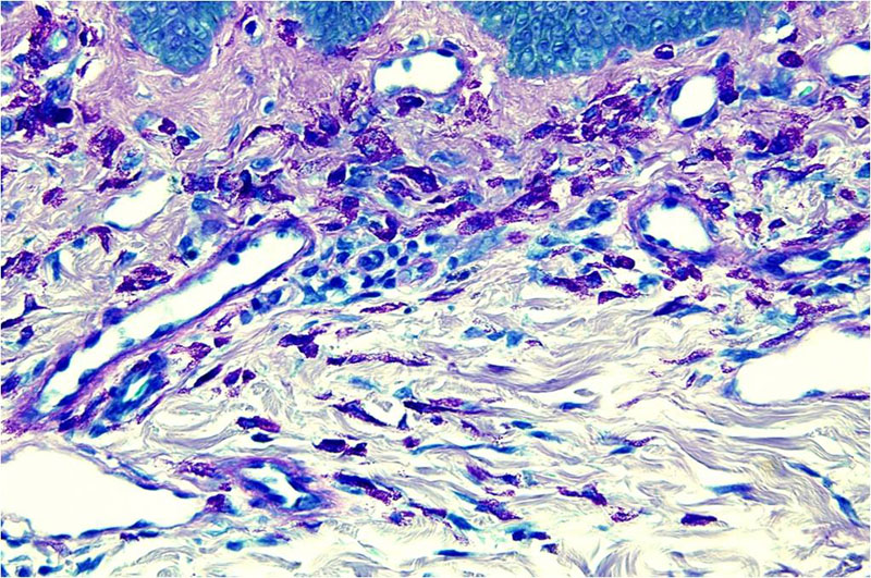 Cutaneous Mastocytosis Diet Foods - conciergeposts