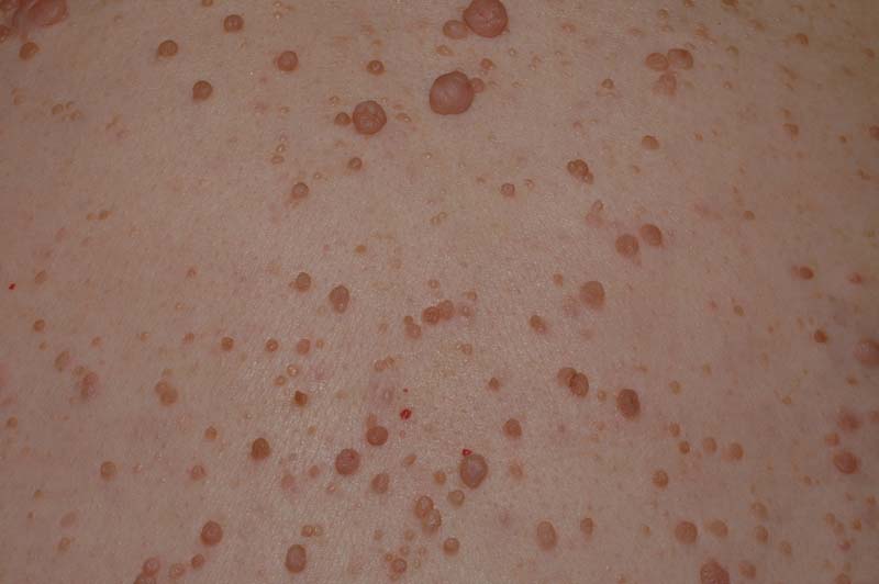 Neurofibroma - The Clinical Advisor