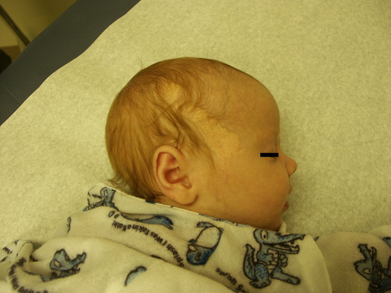 Nevus Sebaceus (Nevus Sebaceus of Jadassohn, nevus epitheliomatous ...