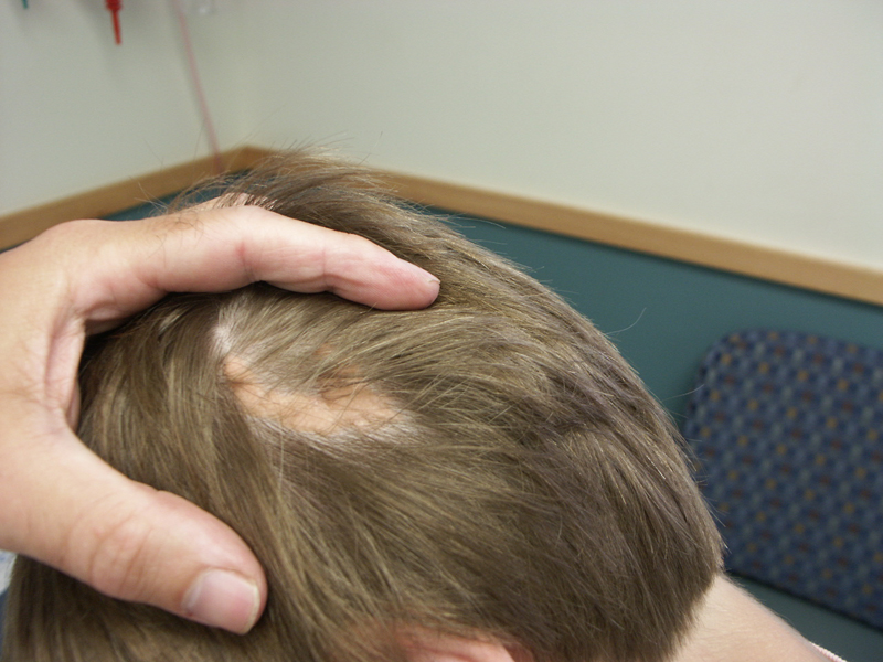 Nevus Sebaceus (Nevus Sebaceus of Jadassohn, nevus epitheliomatous ...