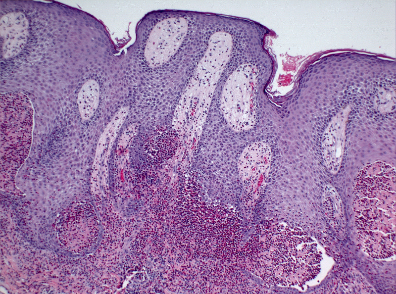 Pemphigus Vegetans (Pemphigus vegetans of Hallopeau, pemphigus vegetans ...