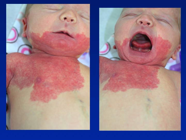 PHACES Syndrome - The Clinical Advisor