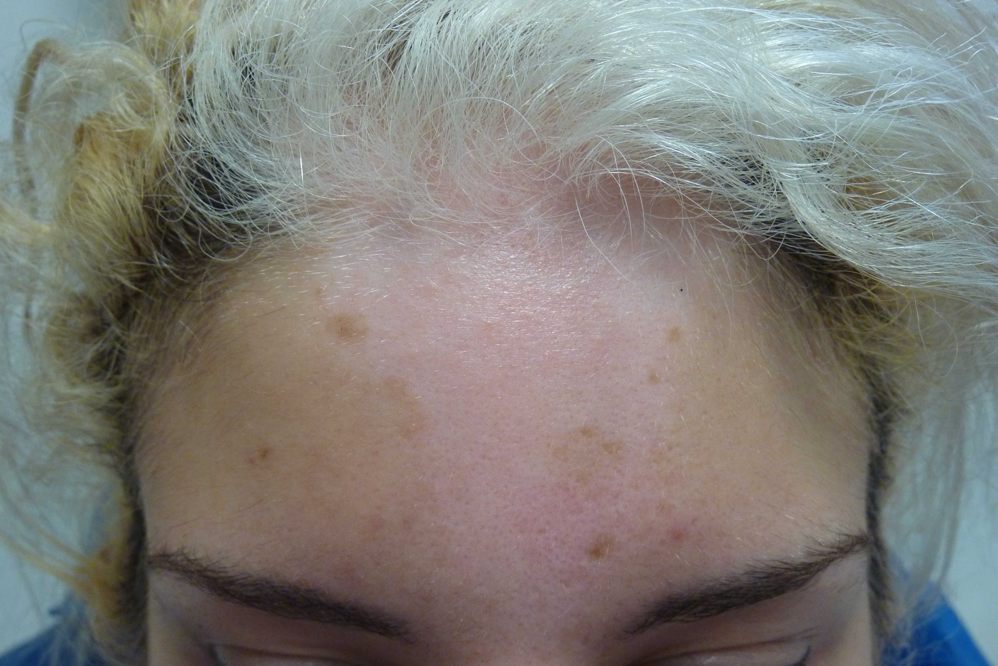 Piebaldism - The Clinical Advisor