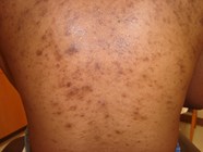 Post inflammatory Hyperpigmentation And Hypopigmentation post Post inflammatory Hyperpigmentation And Hypopigmentation post