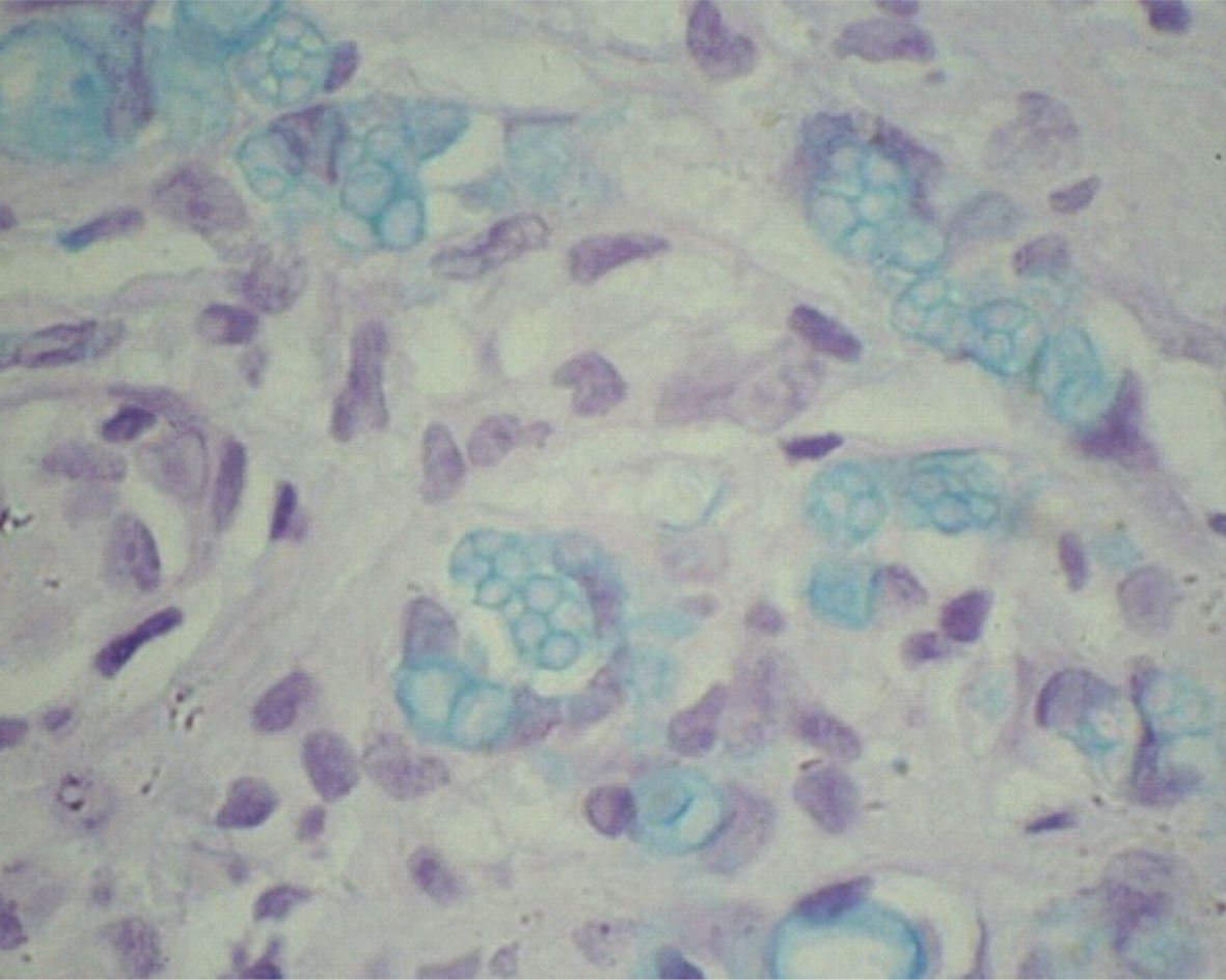 Protothecosis - The Clinical Advisor