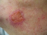 Squamous Cell Carcinoma Of The Skin The Clinical Advisor Squamous Cell Carcinoma Of The Skin The Clinical Advisor