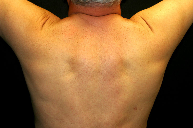 Stiff Skin Syndrome (Mucopolysaccharidosis) - The Clinical Advisor