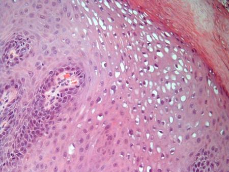 Papillomatosis Cutis Carcinoides Bilder – KFYT