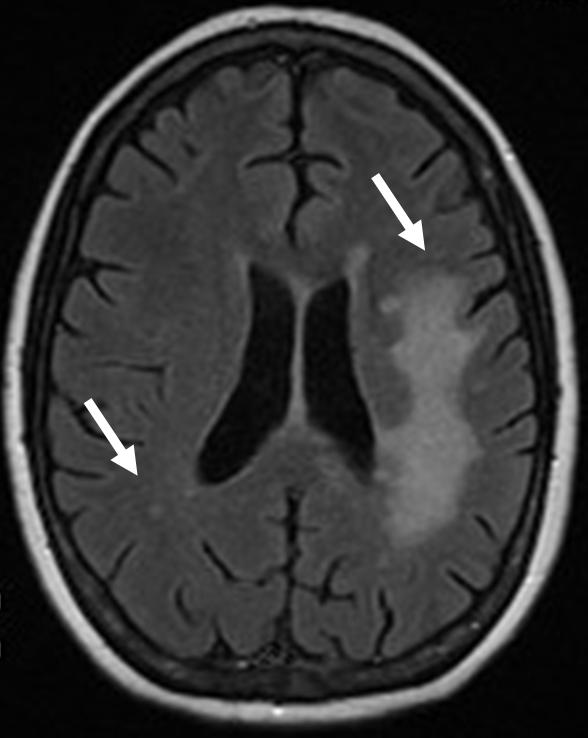 JC polyomaviruses: Progressive Multifocal Leukoencephalopathy ...