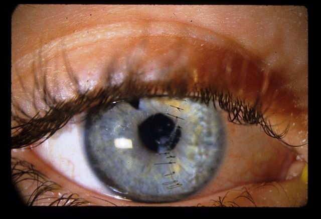 Ocular Laceration - The Clinical Advisor
