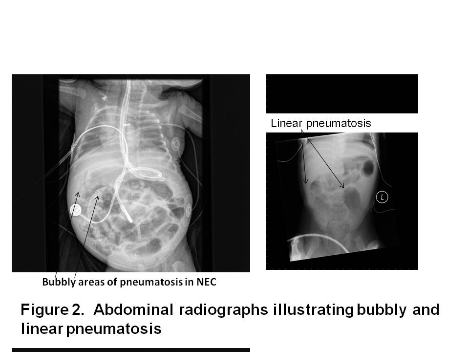 Necrotizing enterocolitis - The Clinical Advisor