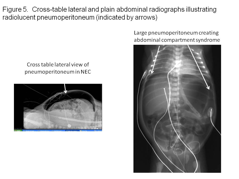 Necrotizing enterocolitis - The Clinical Advisor