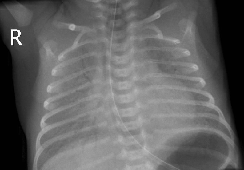 Respiratory distress syndrome - The Clinical Advisor