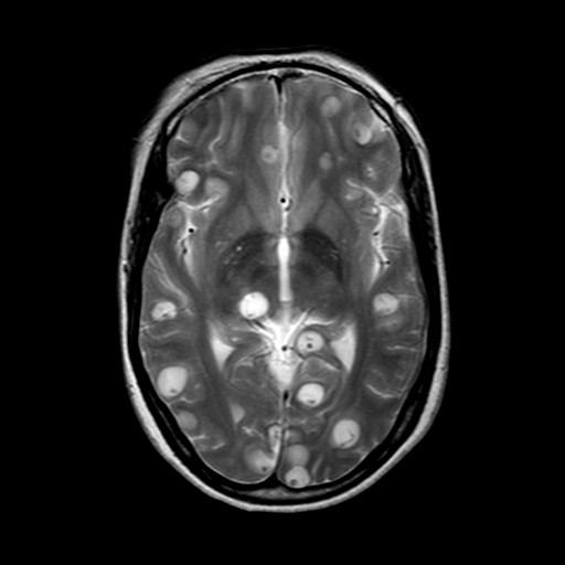 Can You See A Cyst On An Mri at Carlos Day blog