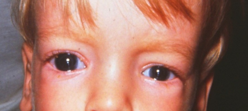 Glaucoma - The Clinical Advisor