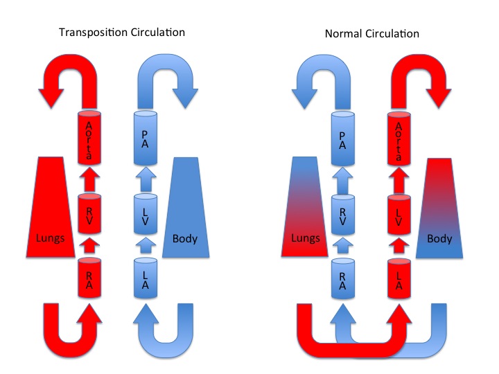 Transposition of the great vessels - The Clinical Advisor