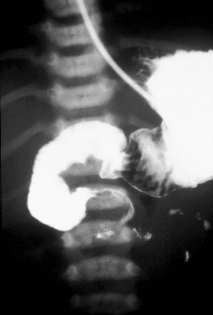 Intestinal malrotation with volvulus - The Clinical Advisor