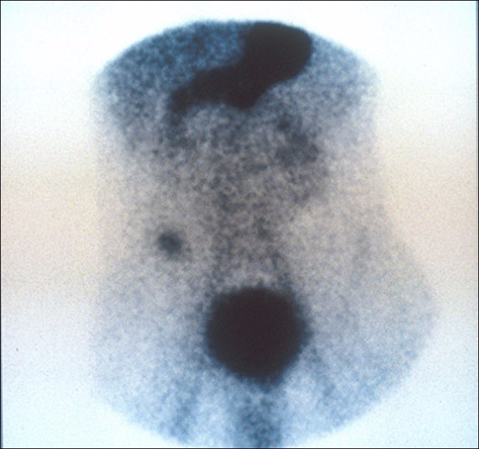 Meckel Diverticulum - The Clinical Advisor