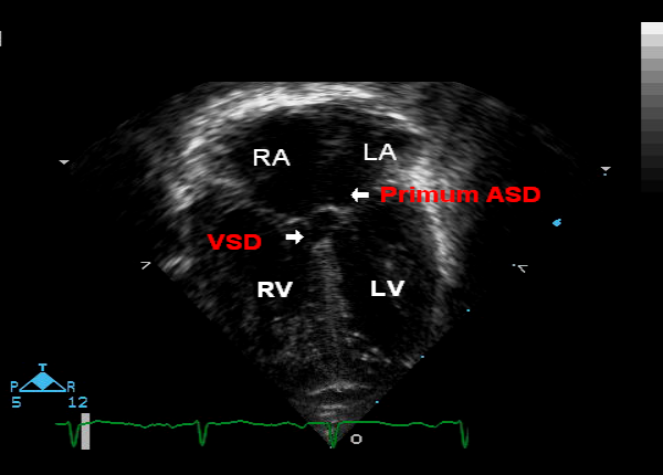 Atrioventricular Septal Defects - The Clinical Advisor