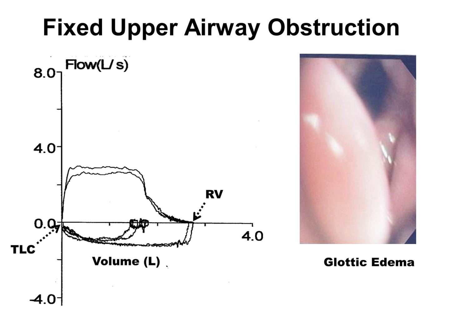 Disorders Of The Central Airways And Upper Airway Obstruction The