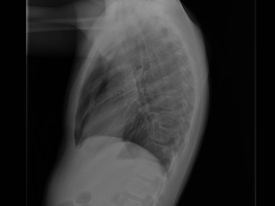 Pneumothorax/pneumomediastinum - The Clinical Advisor