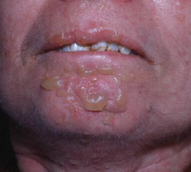 Bullous drug eruptions (dermatitis due to drugs and medicines taken ...