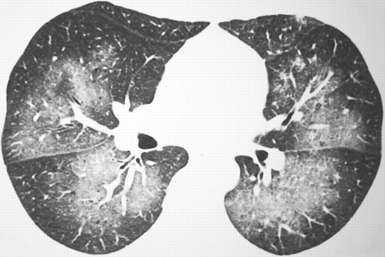 Diffuse Alveolar Hemorrhage, Pulmonary capillaritis - The Clinical Advisor