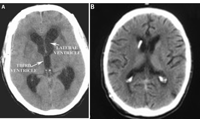 Intracranial hypertension - The Clinical Advisor
