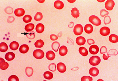 Sideroblastic anemia - The Clinical Advisor