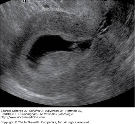 Irregular Bleeding With Iud