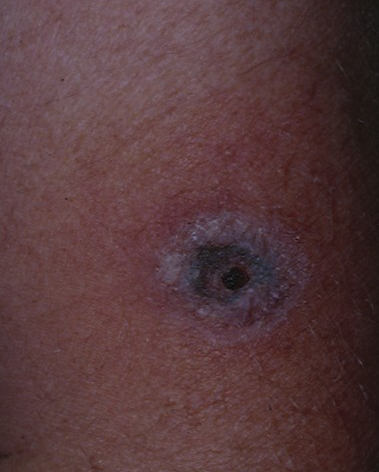 Ecthyma gangrenosum (dermatitis gangrenosa infantum, disseminated ...