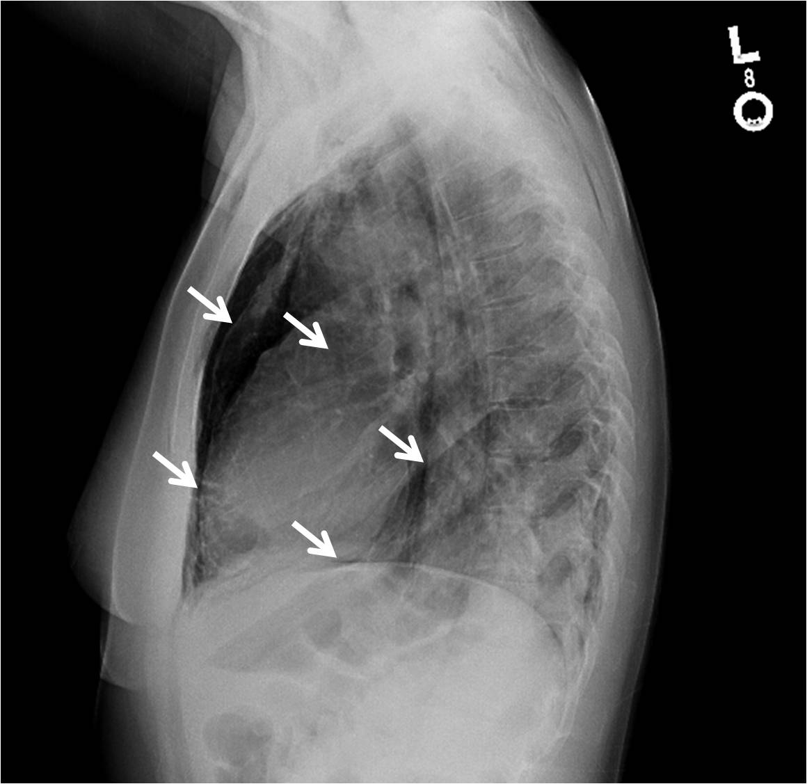 Non-neoplastic Disorders of the Mediastinum: Pneumomediastinum - The ...