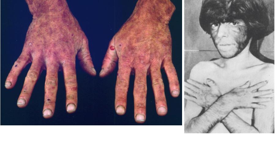 Chronic cutaneous porphyrias - The Clinical Advisor