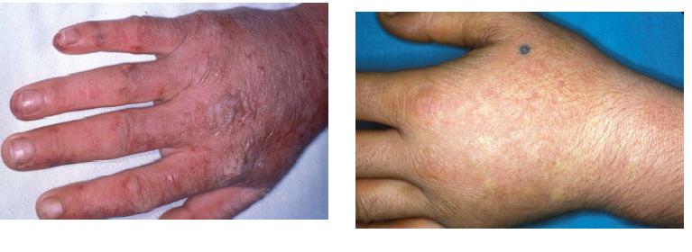 Chronic cutaneous porphyrias - The Clinical Advisor