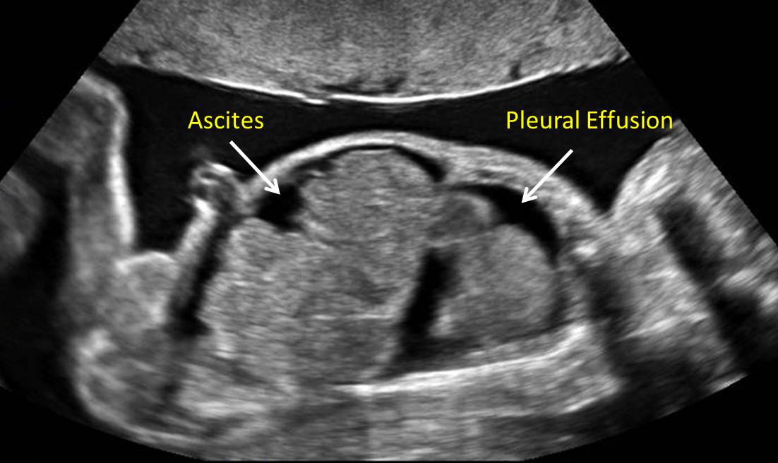 Fetal Tachycardia - The Clinical Advisor