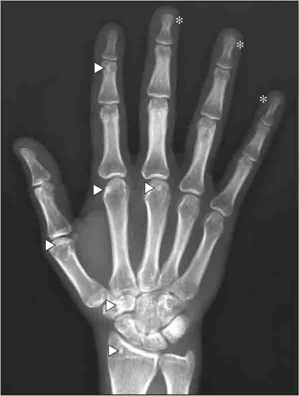 Buschke-Ollendorff syndrome (dermatofibrosis lenticularis disseminata ...