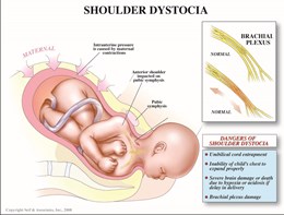 Shoulder Dystocia The Clinical Advisor
