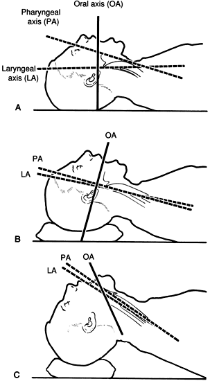 Airway Management, pediatric - The Clinical Advisor